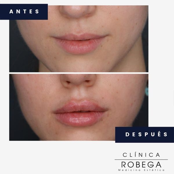 Antes despues aumento de labios mayores – Clínica Robega