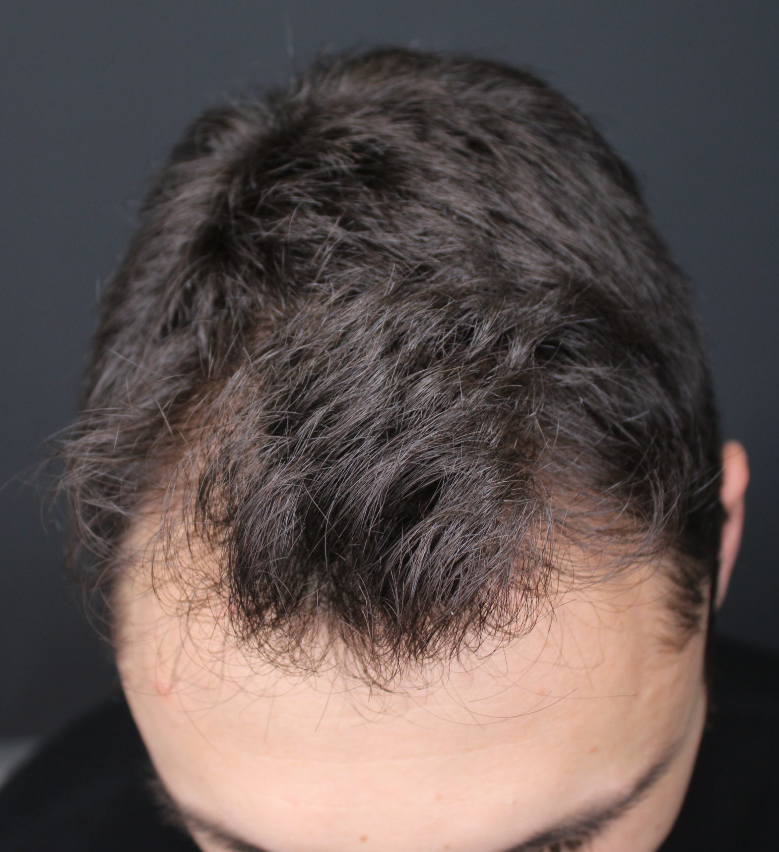 Exosomas, tus aliados contra la alopecia | Clínica Robega